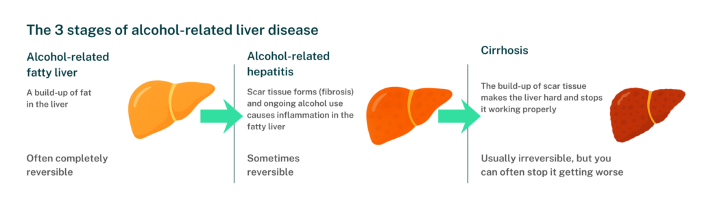 Alcohol-Related Liver Disease - Liver Foundation